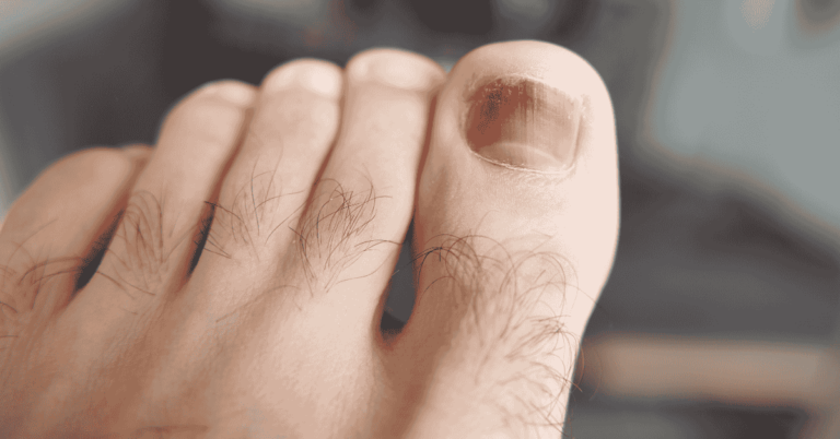 Dealing with Toenail Trauma: Causes and When to Seek Treatment ...