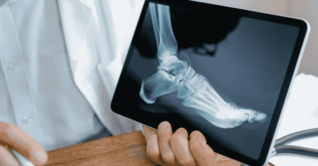 Recognizing the Warning Signs of Stress Fractures in Your Feet ...