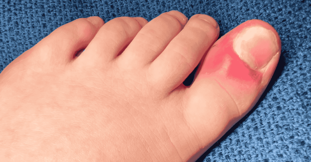 When an Ingrown Toenail Becomes an Infection: What to Watch For ...