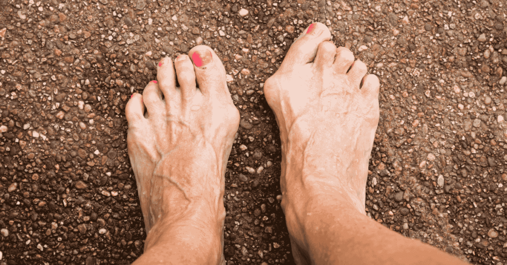 The Truth About Hammertoes: Causes, Progression, and Treatment Options ...